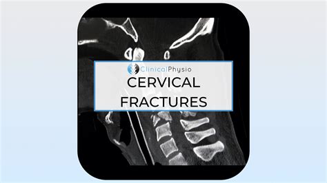 Cervical Fractures Clinical Physio Membership