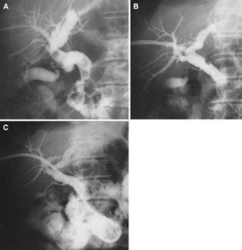 A Patient With Multiple Cbd Lithiasis And Unsuccessful Ercp Due To A