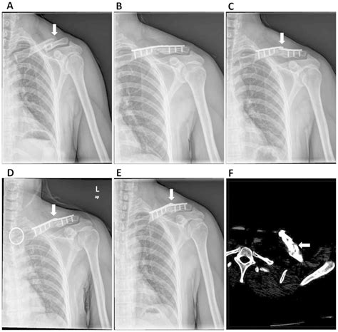 X Ray Broken Collar Bone