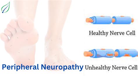 Peripheral Neuropathy Causes Symptoms Treatments Best Back Pain