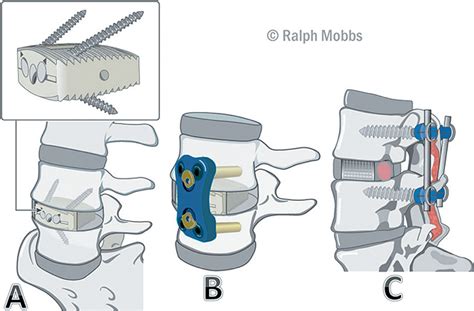 Types Of Lumbar Spinal Fusion Surgery Design Talk
