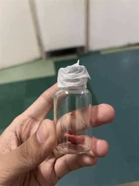 My Wart In A Bottle After Surgery Rwarts
