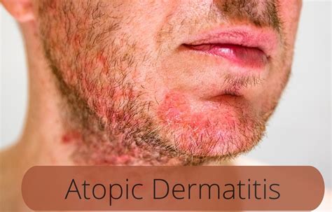 Tralokinumab And Topical Corticosteroids Tied To Sustained Important In Atopic Dermatitis