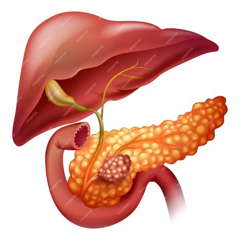 Premium Vector Pancreas Cancer Diagram On White