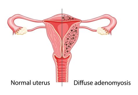 391 Adenomyosis Images Stock Photos 3D Objects Vectors Shutterstock
