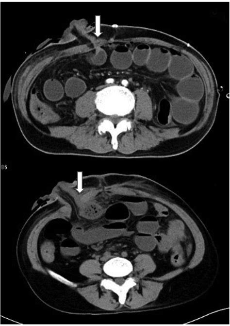 Defunctioning Ileostomy Is A Key Risk Factor For Small Bowel Obstruction After Colorectal Cancer