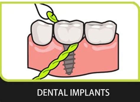 Thornton Bridge And Implant Floss Kleenteeth