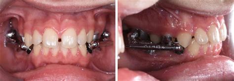 Fixed Bite Correctors To Treat Your Bite Discrepancy