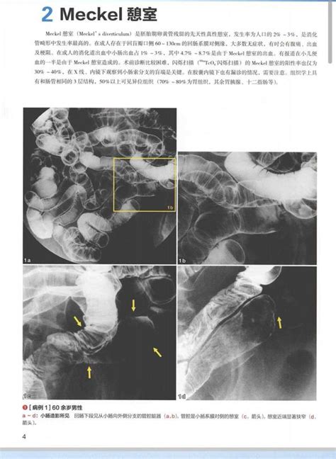 小肠憩室 知乎