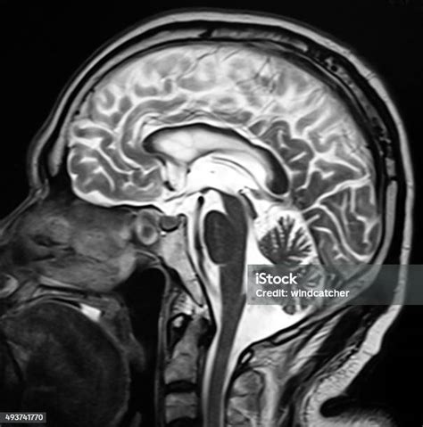 휴머니즘 뇌 Mri 영상 Mri 스캔에 대한 스톡 사진 및 기타 이미지 Mri 스캔 시상 봉합 2015년 Istock