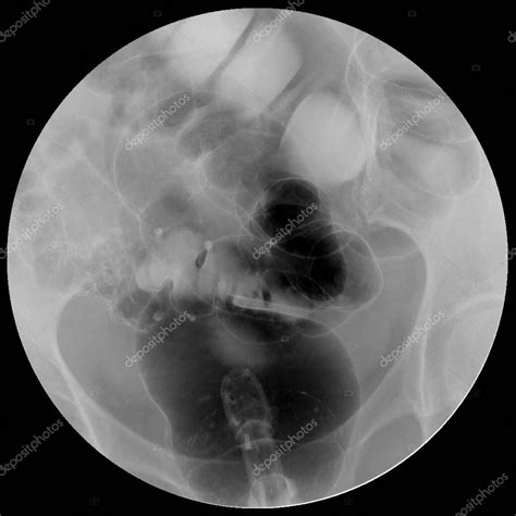 Imagen De Enema De Bario O Vista De Rayos X Colorrectales Que Muestra