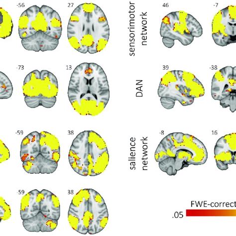 Large Scale Intrinsic Connectivity Brain Networks Patterns Of