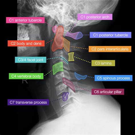Normal Cervical Spine Radiographs Image Radiopaediaorg Cervical Spine