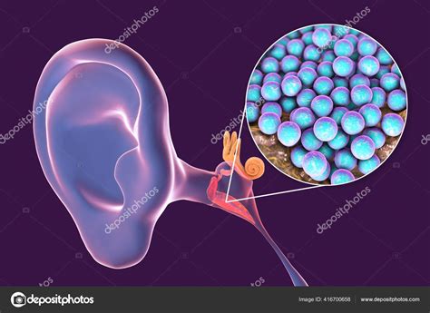 Otitis Media Caused Bacteria Staphylococcus Aureus Inflammatory Disease