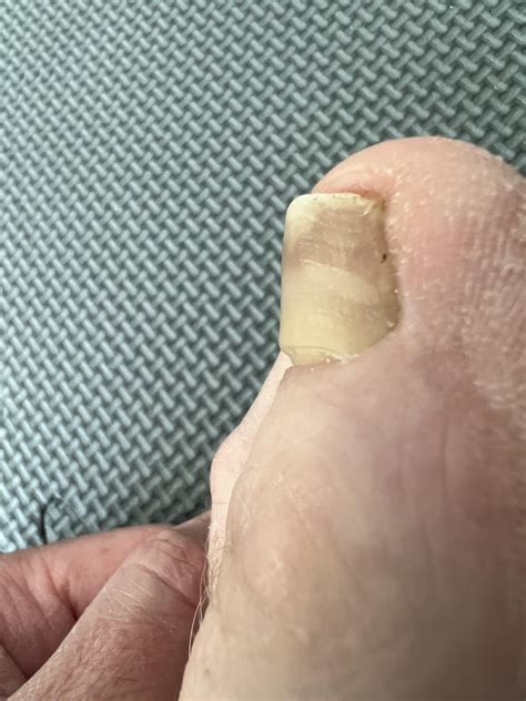 Clarus Tolnaftate Seems To Have Worked Rnailfungus