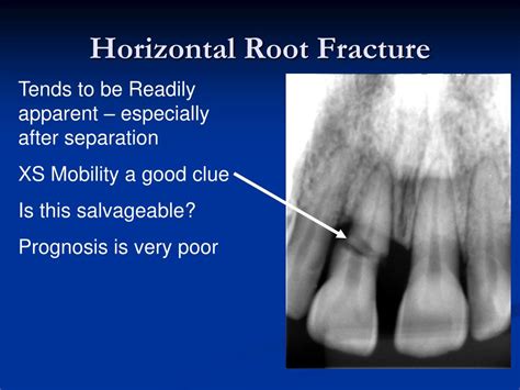 PPT Lecture 9 Traumatic Injuries Cracked Teeth And Vertical Root