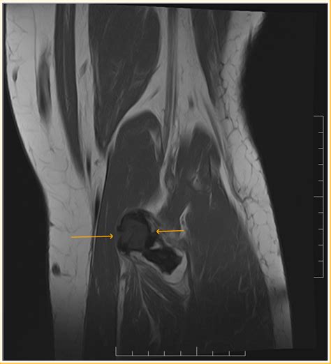 Fibular Osteochondroma Mri Sumers Radiology Blog