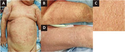 Generalized Pustular Psoriasis Von Zumbusch The American Journal Of