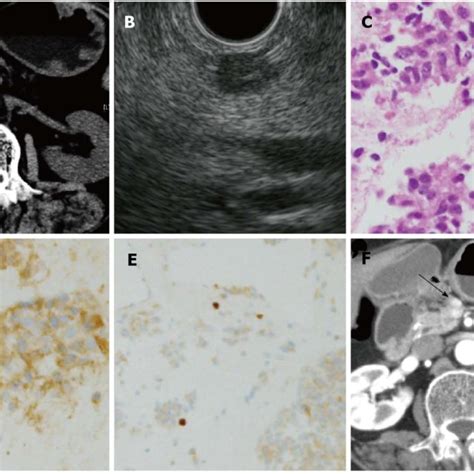 Prognoses Of Pancreatic Neuroendocrine Tumor Grade 1 Patients Download Table