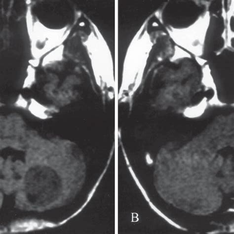 A Axial T1 Weighted Mri Before Contrast Injection Revealing A