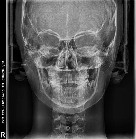 Radiografías Extraorales RXM Radiologia Maxilofacial
