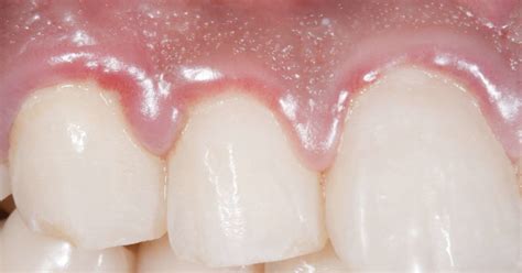 Home Remedy Gum Abscess Stages Be A Large Biog Image Archive