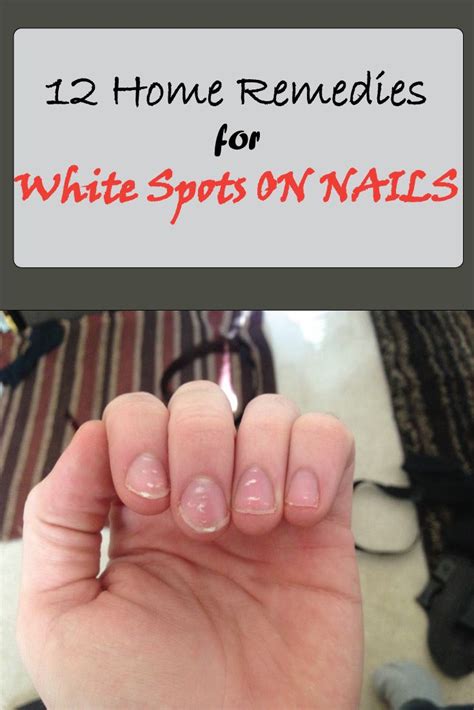 White Spots On Nails Zinc Deficiency Web Kreativitas