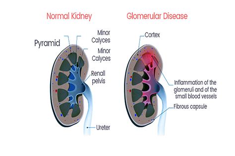 Glomercular Disease Dr Pinaki Mukhopadhyay