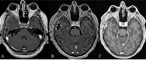 Contrast Enhanced Mr Images Show A Right Temporal Abscess With Rim Download Scientific Diagram