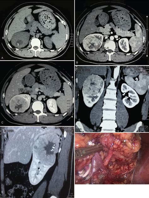 Sporadic Renal Hybrid Oncocyticchromophobe Tumor In A Young Medicine