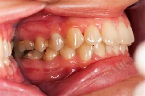 Gum Cancer Symptoms Treatment Prognosis Cancer