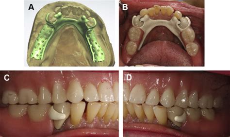 Revisiting The Removable Partial Denture Pocket Dentistry