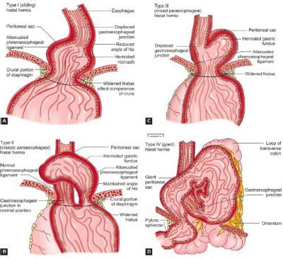 Hiatal Hernia Torrance Digestive Disease Institute