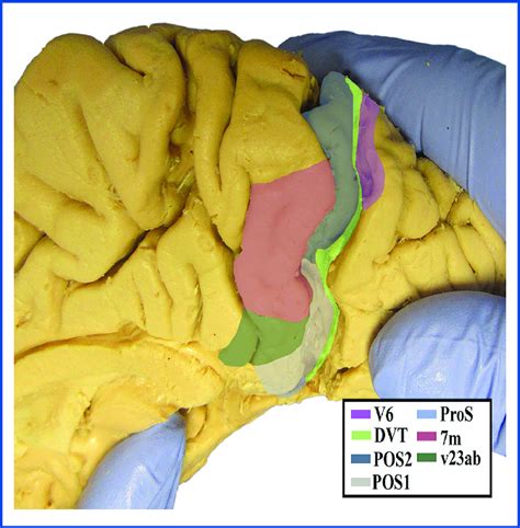 Anatomic View Of The Parieto Occipital Sulcus Parcellations Pos2 Pos1