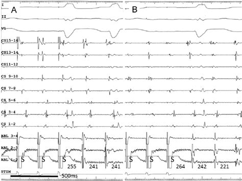 Entrainment Pacing At An S S Pacing Cycle Length Of 220 Ms From The