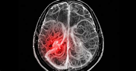 Thrombectomy For Basilar Artery Occlusion Relias Media