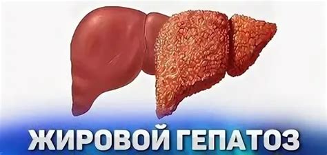 Жировой гепатоз на животе - фото презентация