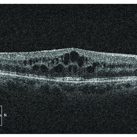 Spectral Domain Optical Coherence Tomography Showing Cystoid Macular