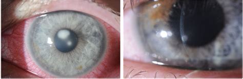 Bandage Contact Lens And Topical Steroids Are Risk Factors For The