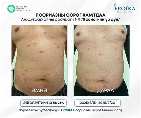 Froika Psoriasis Mongolia Хайрст үлд зөвлөгөө Facebook