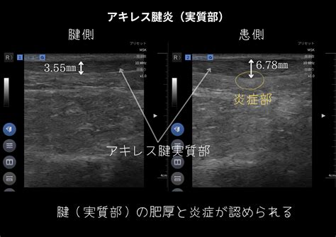 アキレス腱炎～放っておいてはダメ！～ よねくら接骨院【稲城市】 ★急患対応★怪我を早く治したい方整形外科基準の施術と最新の機器で患者さん