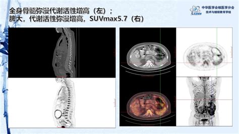 Csnm E Pet Ct