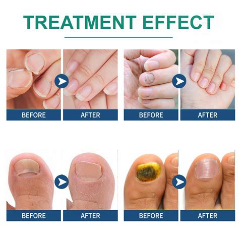 32 Pacthes Tea Tree Oil Extra Strength Fungal Nail Patches Nail Fungal