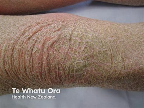 X Linked Ichthyosis Ichthyosiform Disorders Ppt Download