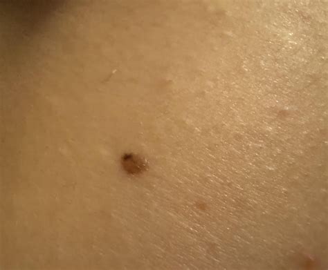 Does It Look Like Melanoma I Am Terrified Rmelanoma