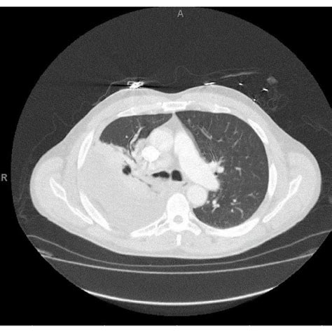 Chest X Ray Showing Right Sided Consolidation Download Scientific