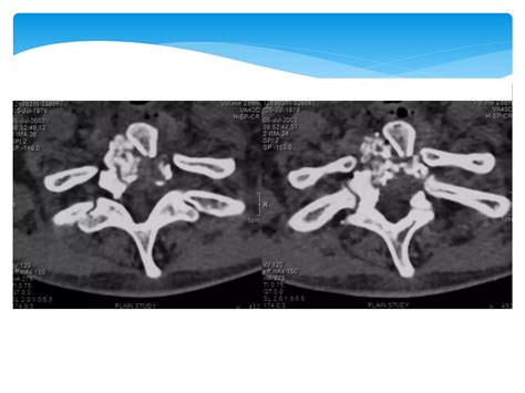 Management Of Tuberculosis Of Cervicothoracic Junction Ppt