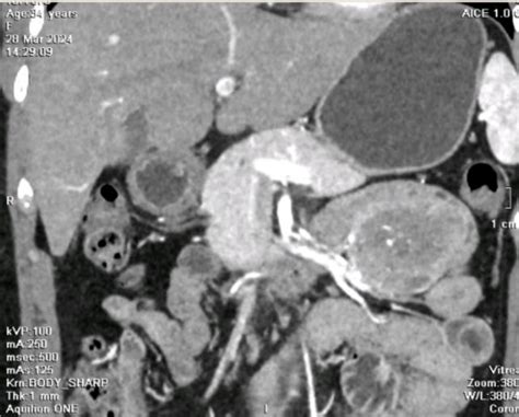 Vietnamese Medic Ultrasound Case 771 Bowel G I S T Dr Phan Thanh HẢi Dr LÊ ThỐng NhẤt Medic