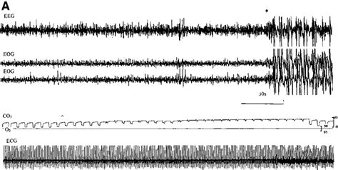 A Representative 4 Min Segment Of A Polysomnogram Recording