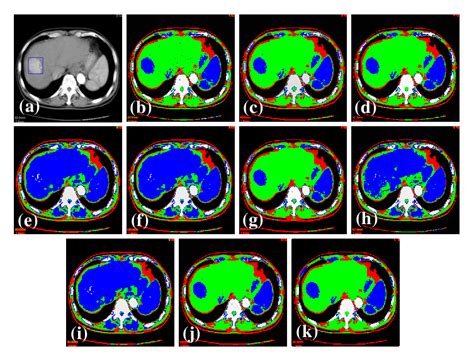 comparison of segmentation results on the liver ct image a original